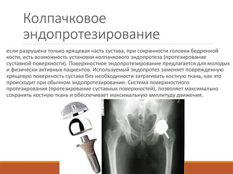 Эндопротезирование тазобедренного коленного суставов презентация онлайн