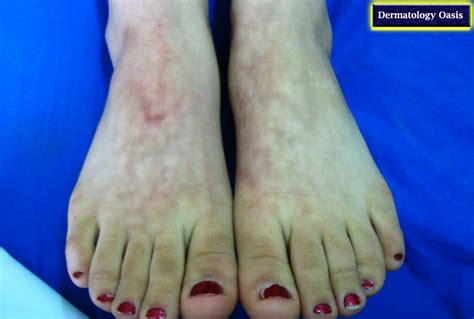 Livedo Reticularis Dermatology Oasis
