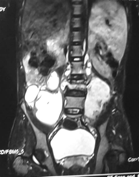 Psoas Abscess Abscess Psoas Iliopsoas Abscess