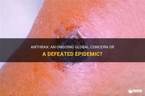 Anthrax An Ongoing Global Concern Or A Defeated Epidemic Medshun