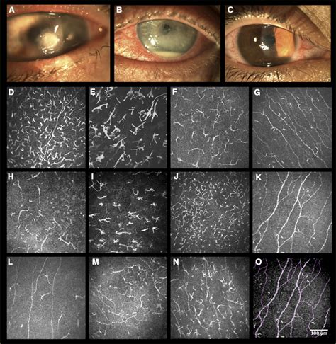 Corneal Subbasal Nerve Plexus And Dendritic Cells A Slit Lamp Photo Download Scientific