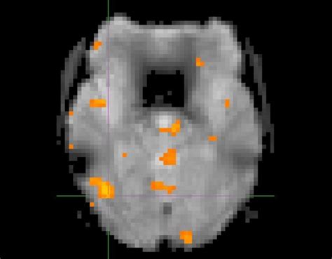 Axial Slice View Of The Activated Voxels For The Real Left And