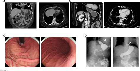 Myocarditis And Myositis Myasthenia Gravis Overlap Syndrome Induced By