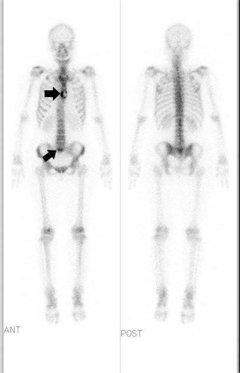 Bone Scintigraphy Shows Increased Uptake In The Body Of Sternum And Download Scientific