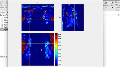Video Integrated Synchronization And Triplanar Reconstruction Of 4d B Mode And Color Doppler