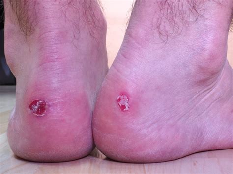 Tinactin Vs Lotrimin Which Is The Best Treatment For Athletes Foot