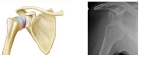 Subluxation And Dislocation Flashcards Quizlet