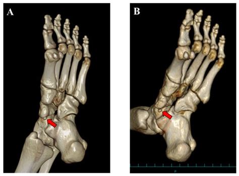 Navicular Tubercle