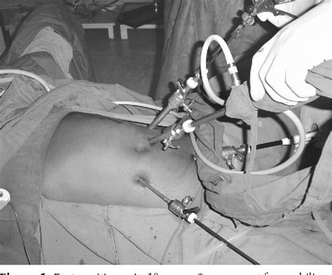 Figure 1 From Laparoscopic Restorative Total Proctocolectomy With Ileal Pouch Anal Anastomosis