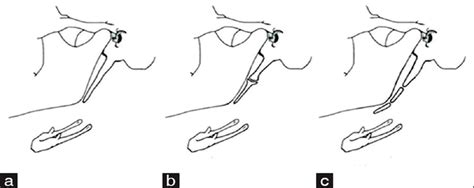 Styloid Process Morphology A Type I B Type Ii And C Type Iii