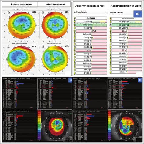Case 4 Postoperative Outcomes A Axial Sagittal Map On Pentacam Download Scientific Diagram