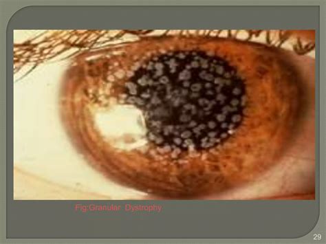 Corneal Degeneration And Dystrophies Pptx