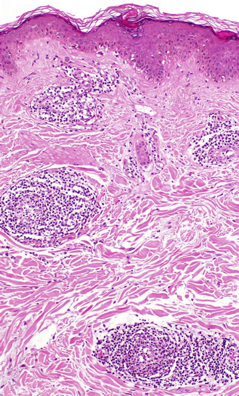 Erythema Annulare Centrifugum Pathology