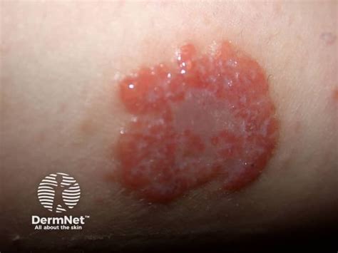 Blistering Skin Conditions