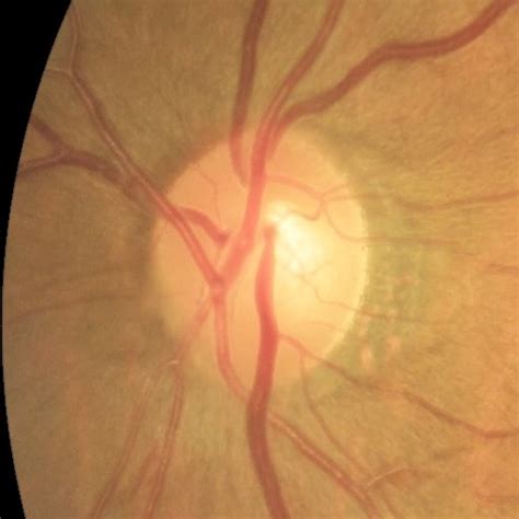 Qualitative Comparison On Partially Supervised Optic Disc And Cup Download Scientific Diagram