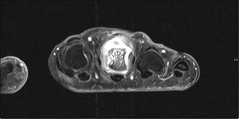 Example Of A Patients Hand With Synovitis Metacarpophalangeal Iii Download Scientific Diagram
