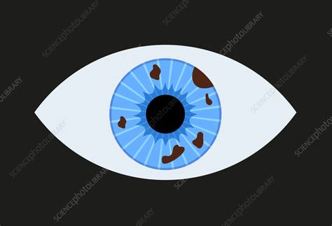 Iris Melanoma Illustration Stock Image F0437246 Science Photo