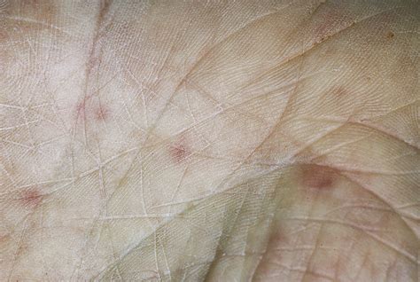 Image Infective Endocarditis Janeway Lesions Merck Infective
