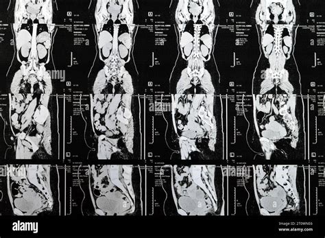 Cairo Egypt October 3 2023 Multi Slice Ct Scan Abdomen And Pelvis Shows Right Ovarian Cyst 3
