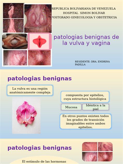 Patologías Benignas De Vulva Y Vagina Pdf Vagina Neoplasias