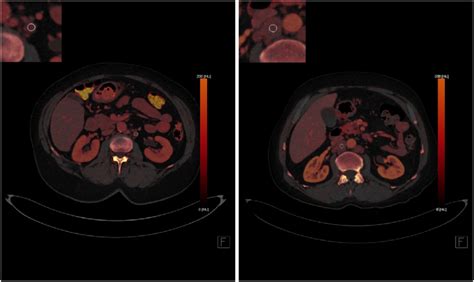 Illustration Of Dect Iodine Quantification Segmentation Axial Dect