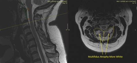 Cervical Multifidus Muscle Atrophy A Literature Update Regenexx