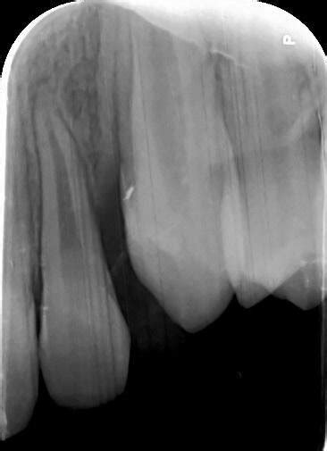 Periapical X Ray Showing Superficial Bone Resorption And Widening Of