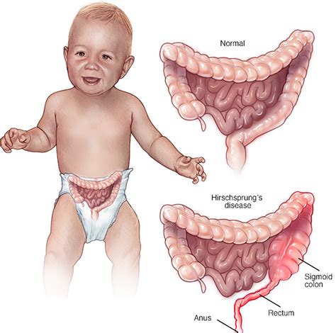 Rectal Biopsy For Hirschsprung Disease Captions Hunter