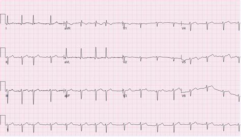 Wandering Atrial Pacemaker Wikiwand