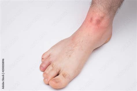 Flat Red Spots On Feet