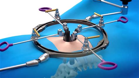 The Supine Alif Access System Offers Both Rigidity And Radiolucency This System Features A Dual