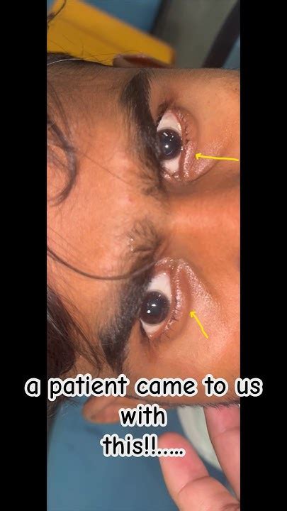 A Case Of Nystagmus👀 Mbbs Aiims Neet Shorts Nystagmus Vertigo Optha Doctor Trending