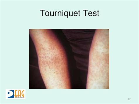 Ppt 1 Dengue An Overview Powerpoint Presentation Free Download