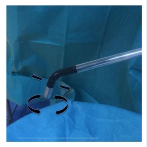 Video Assisted Thoracoscopic Lobectomy Port Placement Ports Were Download Scientific Diagram