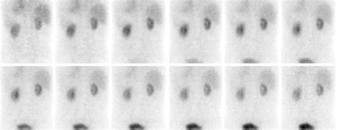 99mtc Mag3 Image Wisely Pmc