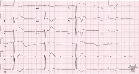 Third Degree Atrioventricular Block Ecg Stampede
