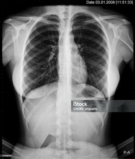 흉부 X선 검사 엑스레이 이미지에 대한 스톡 사진 및 기타 이미지 엑스레이 이미지 여성 X 레이 Istock
