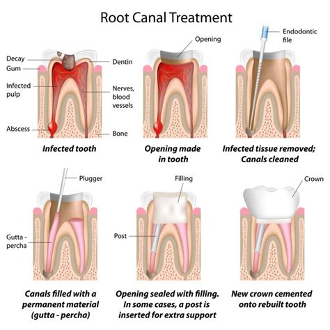 Debunking Outdated Myths Root Canals And Cancer