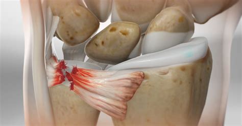A Guide To Understanding Tfcc Tear Symptoms And Treatment Options