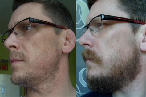 Patchy Beard Success Stories Before And After Photos Page Beard Board