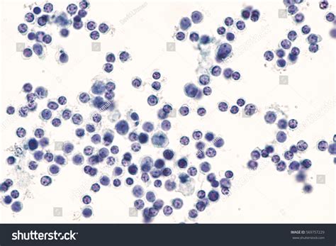 Benign Pleural Fluid Cytology Chronic Inflammatory Foto De Stock