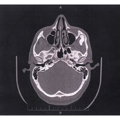 Resected Osteochondroma And Coronoid Process Download Scientific Diagram