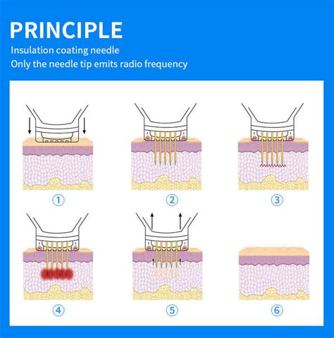 3d Rf 마이크로 니들 동양레이저 고출력 다이오드 레이저 전문업체 And 다이오드 펌핑 고체 모듈 Dpss 레이저
