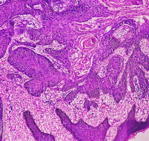 Tissue From Axilla Biopsy Invasive Squamous Cell Carcinoma Smear