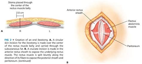 End And Diverting Loop Ileostomies Creation And Reversal Abdominal Key