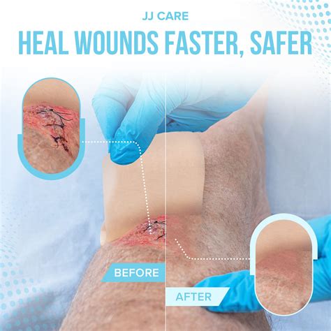 Jj Care Hydrocolloid Dressing 6x6 Pack 5 08mm Thick Large Hydrocol