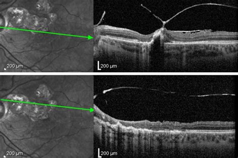 Epiretinal Membranes Looking Beyond The Macula Mivision