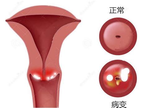 轻度宫颈糜烂 28 有来医生