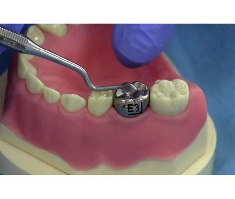 Stainless Steel Crown Prep Dimensions At Julia Belcher Blog