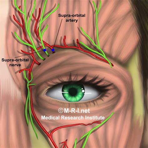Supratrochlear Nerve Block